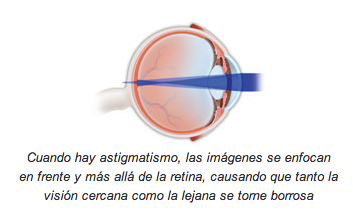 Daponte Ojos | Astigmatísmo